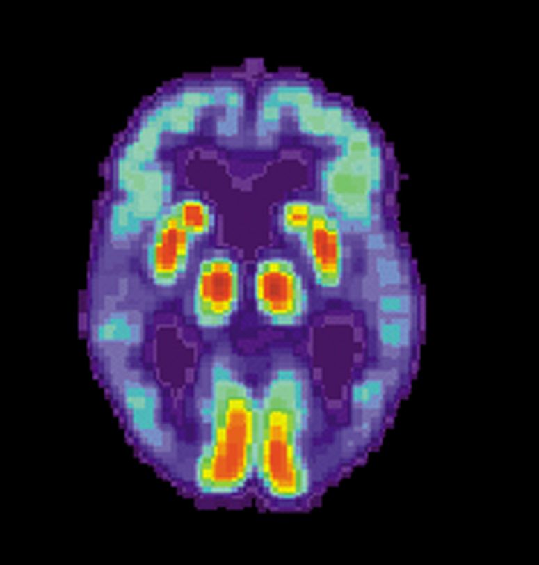 First Blood Test To Diagnose Alzheimer s Now Available For Purchase